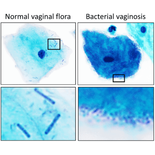 Bacterial Vaginosis Overview - Causes, Symptoms & Treatments - Drug Genius